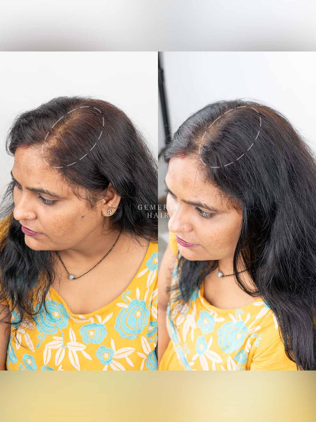 Shop Invisible Side Patches | Side Patches Hair Extensions - Gemeria Hair