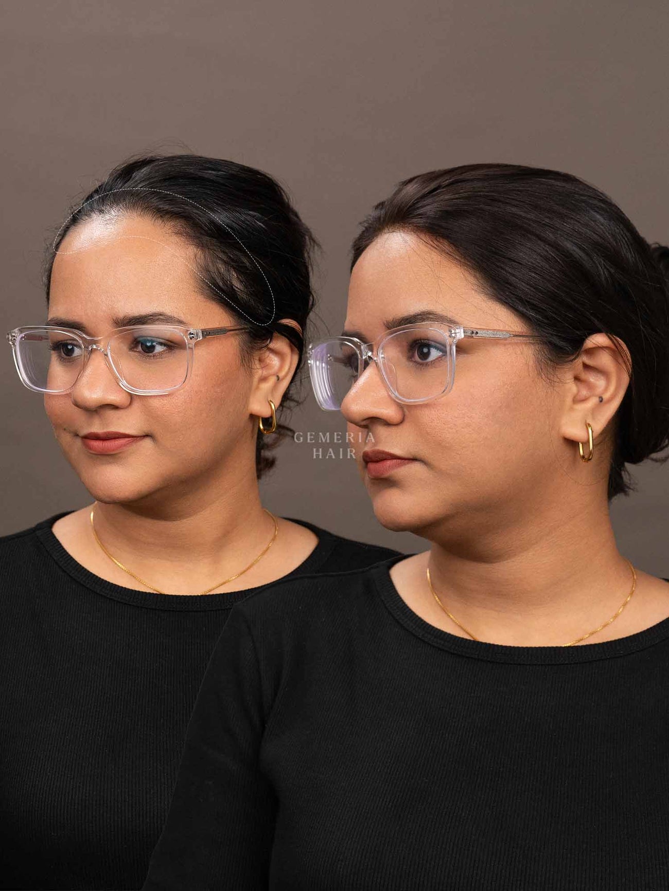 Shop Front Hairline Topper | Cover Thinning Hairline - Gemeria Hair